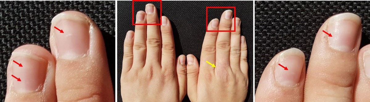 Arsenic Poisoning Fingernail Signs